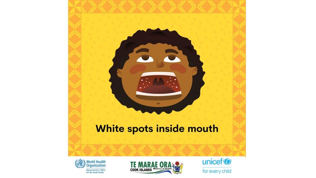 Symptoms of Measles Poster – Te Marae Ora Cook Islands Ministry of Health